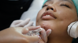 Ini Alasan Mengapa Kamu Harus Filler Dagu – NOVIS News